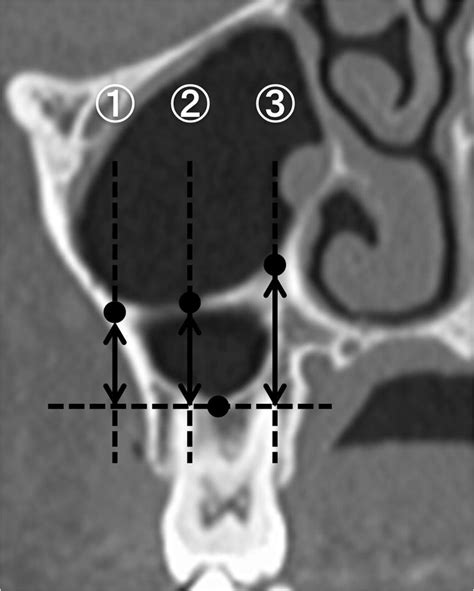 The Heights Of The Maxillary Sinus Septa Were Measured At Three Sites