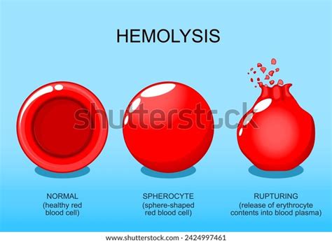 Hemolysis Normal Red Blood Cell Spherocyte Stock Vector Royalty Free