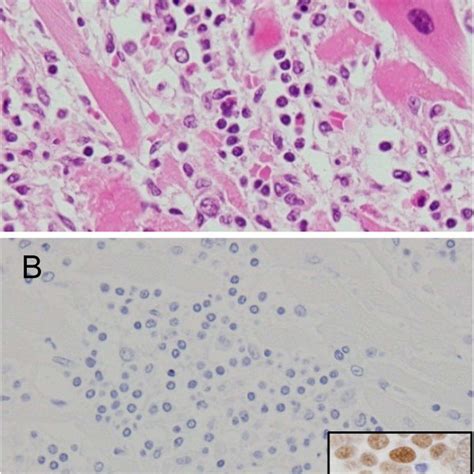 Immunohistochemistry For Mcpyv In Tissue Samples A Hematoxylin And