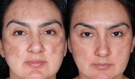 180 Aha Peel Skin Discolouration Skin Facial Peel