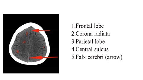 Ct Scan Of Brain CT Scan MRI