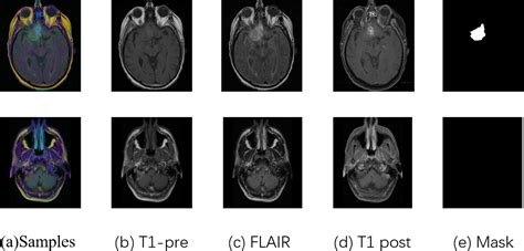 Figure 1 From An Automatic Glioma Segmentation System Based On A Separable Attention U Net