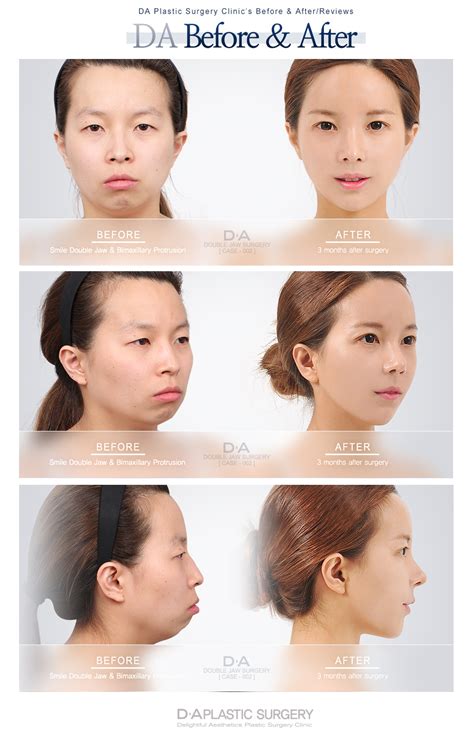 Maxillary Protrusion