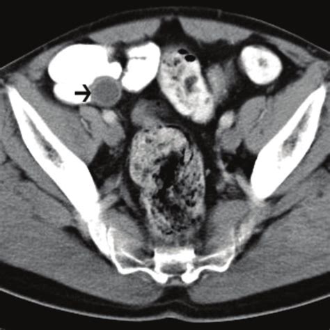 Gross Appearance Of The Resected Appendix Download Scientific Diagram