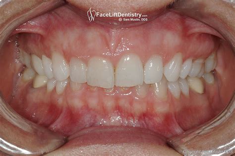 Overbite Correction Explained Adult Options And Treatment