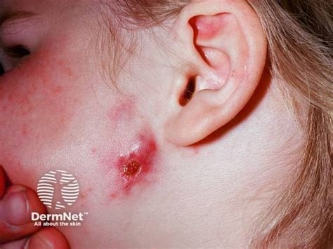 Fistulas And Sinuses Of The Neck And Face Fistulas And Sinuses Of The Neck And Face