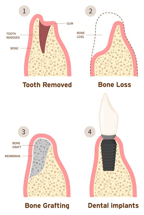 Dental Bone Grafting In Everett Wa Young Dental Care