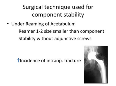 Intraoperative Acetabular Fracture And Pelvic Discontinuity In Thr Ppt