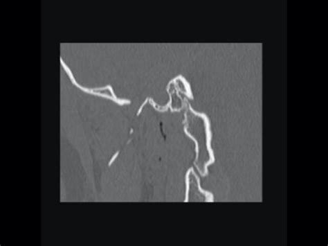 Normal Temporal Bone Ct With Annotated Images Radiopaedia 84293 99584 Poschl Annotated Nc