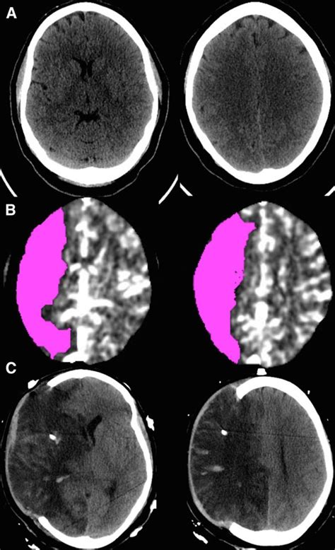 Automated Ct Perfusion Ischemic Core Volume And Noncontrast Ct Aspects Alberta Stroke Program