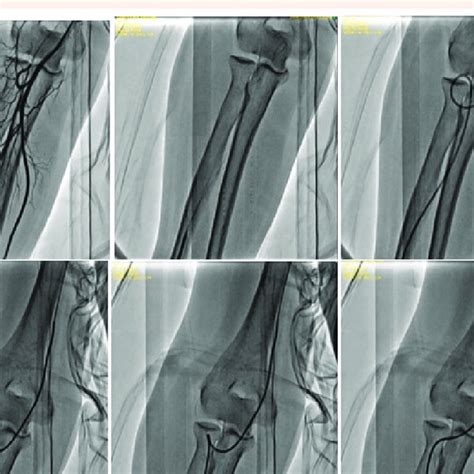 A F Radial Artery Loop And Necessary Steps To Overcome The Loop A Download Scientific
