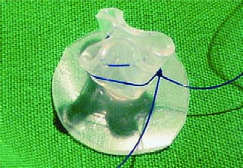 Septal Button After The First Tie Was Secured Download Scientific