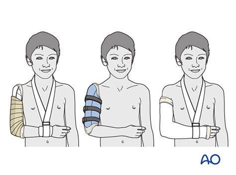 Immobilization With Splint Brace Or Cast For Simple Complete Oblique