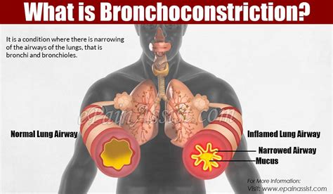 Bronchoconstrictioncausessymptomstreatmentprognosis