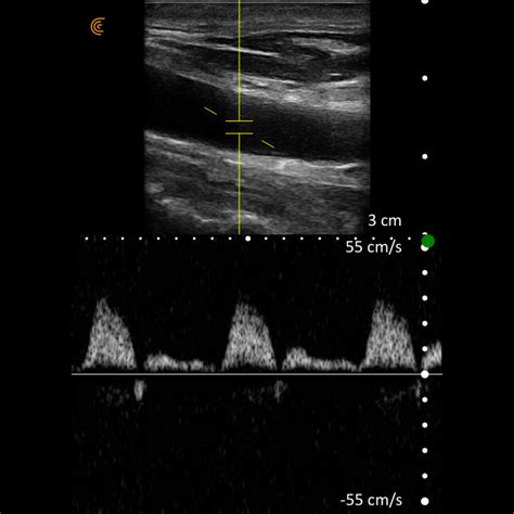 Carotid Doppler And Aortic Stenosis