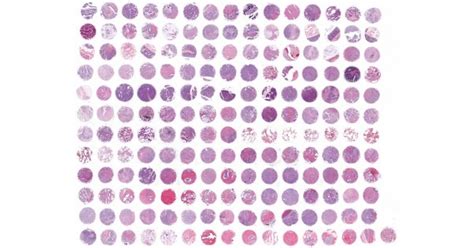 mc1809a multiple organ tumor with normal tissue array including