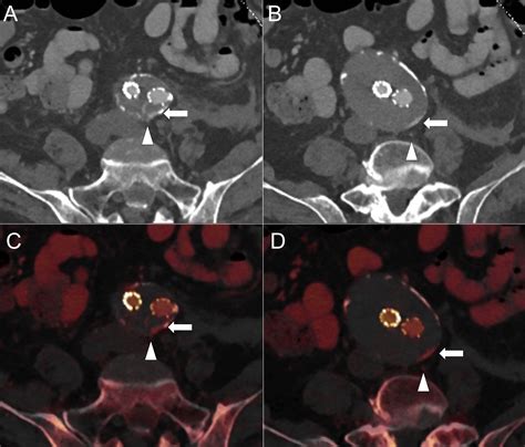 Endoleak Types Radiopaedia At Jamie Kingsbury Blog