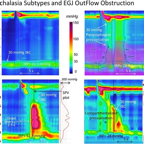 Scheme Of The Chicago Classification Cc V40 In A Major Departure Download Scientific