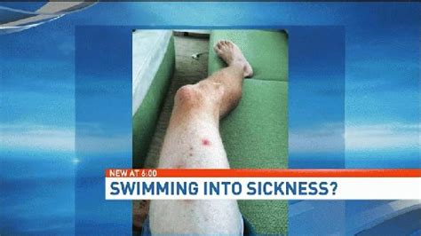 Doctors Say Man Severe Leg Infection Is Most Likely From The Water
