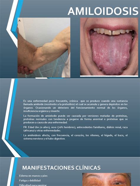 Amiloidosis Tipos Y Tratamientos Pdf Corazón Riñón