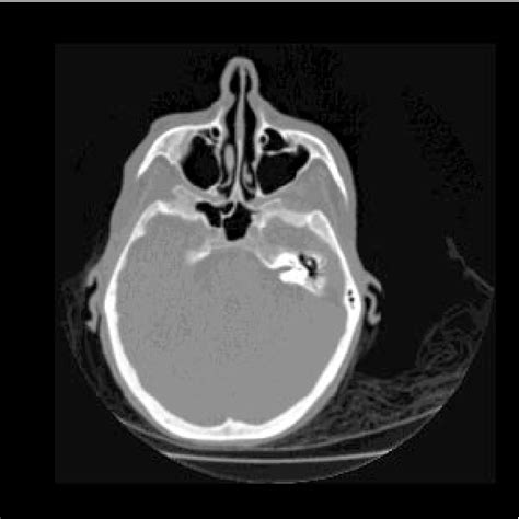 Figure 11 From Two Methods For Iso Surface Extraction From Volumetric Data And Their Comparison