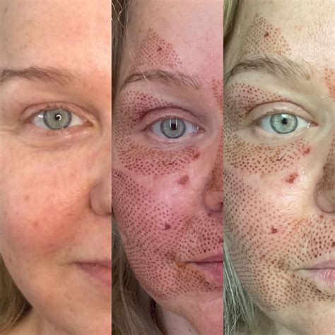 Fibroblast Plasma Pen Skin Tightening Part 3 — Hibiskus Beauty