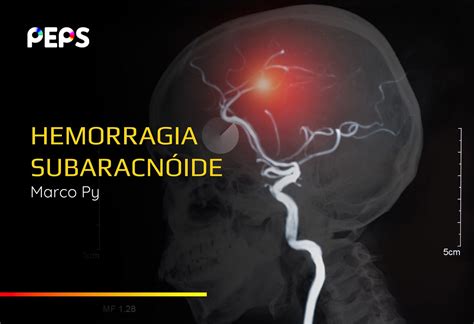 Hemorragia Subaracnóide Traumática Sequelas Retoedu