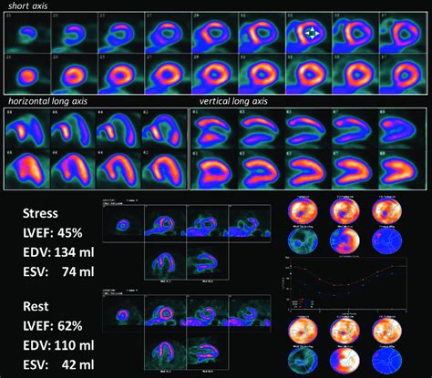 High Risk Myocardial Perfusion Positron Emission Tomography Computed Download Scientific