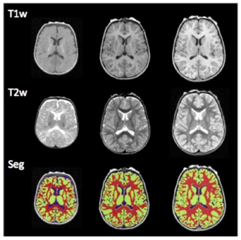 Mri Brain T1 Vs T2 T1w Vs T2w Ayspak