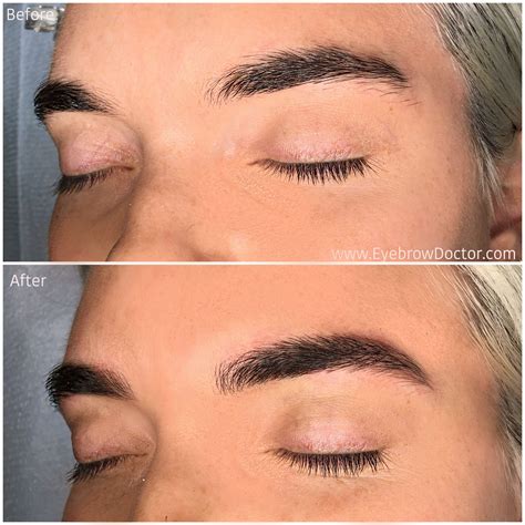 What Is The Purpose Of The Aftercare Ointment After The 52 Off