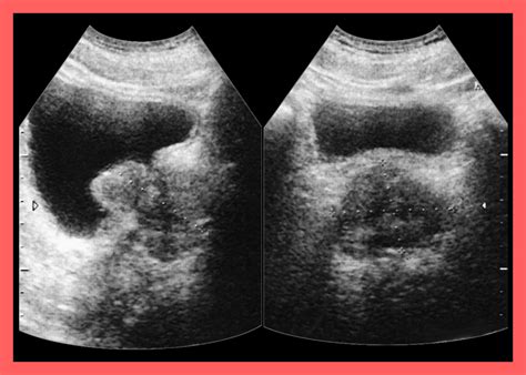 가족력이 많은 영향을 끼치는 전립선암 건강검진정보