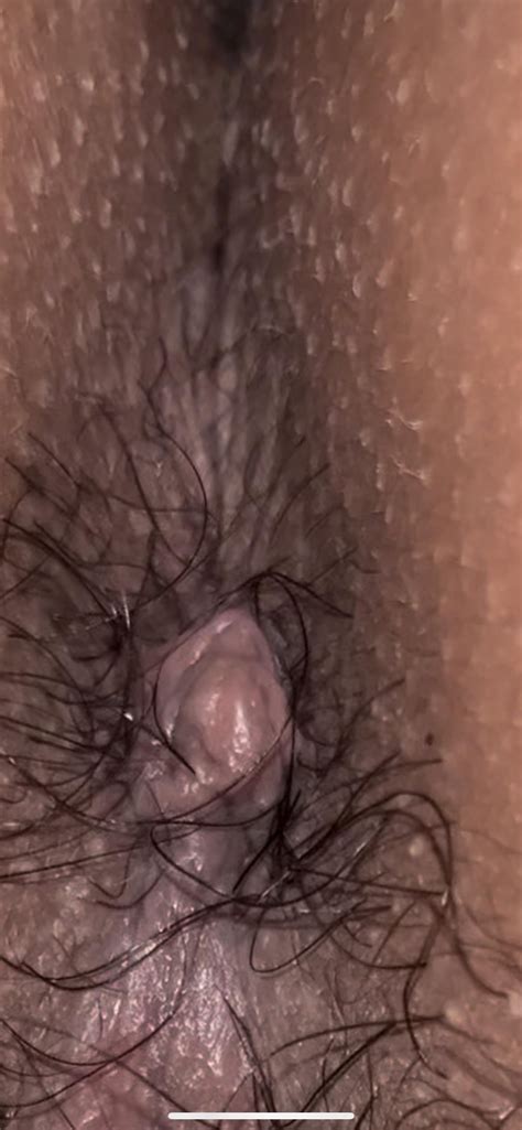 Does Anyone Know What Is This There Is Lump In My Anus Before This