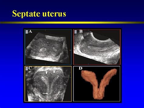 Ultrasonography In Management Of Subfertility Dr Ernest Hung