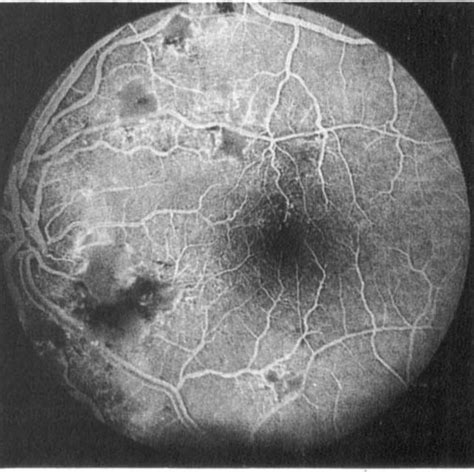 A Mid Venous Phase Angiogram Left Posterior Fundus Case 2 There Is