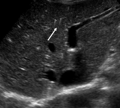 Echogenic Ultrasound