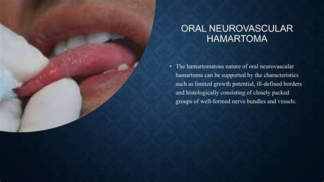 Hamartoma Pptx