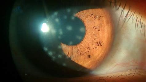 Superficial Punctate Keratitis Spk