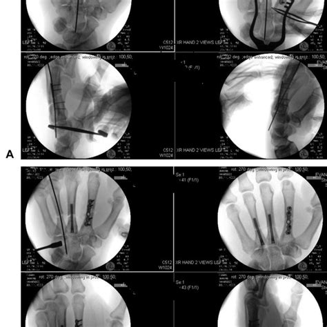 Pdf Antegrade Intramedullary Screw Fixation A Novel Approach To Metacarpal Fractures