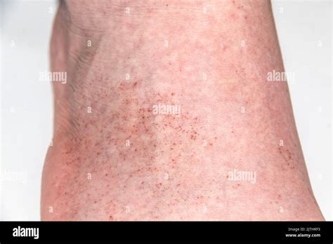 Salmonella Symptoms Skin Rash At Ashley Pines Blog