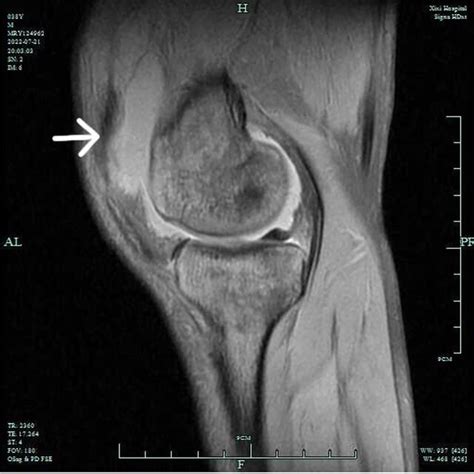 Mri Of The Left Knee Joint Revealed Numerous Patchy Long T1 And Long T2