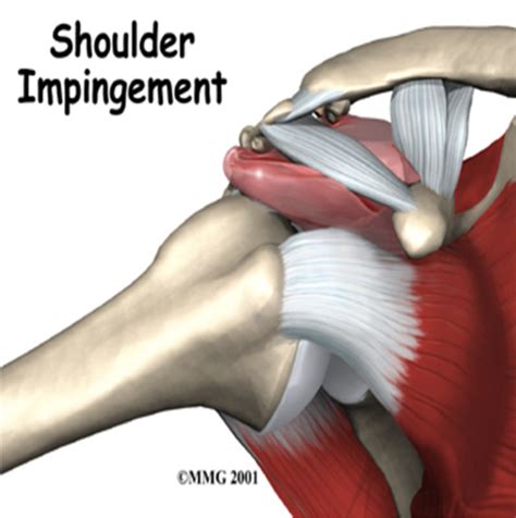 Impingement Syndrome Brisbane Knee And Shoulder Clinicbrisbane Knee And Shoulder Clinic