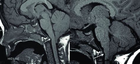 C E Sagittal C T2 And D And E T1 Weighted Mri Demonstrates