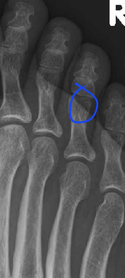 Smacked My 4th Toe Super Hard And Got An X Ray To Check For A Fracture
