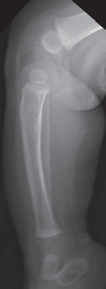 Female Tibia And Fibula Radiology Key
