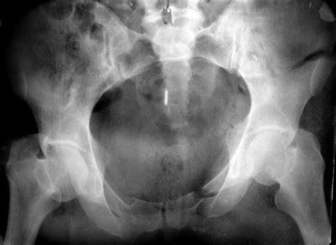 Переломы крыла подвздошной кости