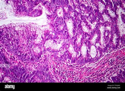 Photomicrograph Of Colon Adenocarcinoma Illustrating Malignant