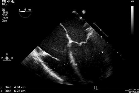 Initial Transesophageal Echo Imaging Demonstrating Severe Dilation Of