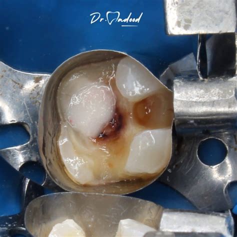 Mta Putty Pulp Capping Using Wellroot Putty Materials With Direct Composite Buildup Myzerodonto