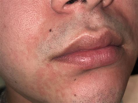 Red Blotches On Face Rdermatologyquestions