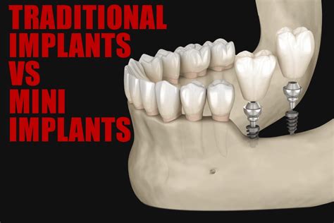Traditional Implants Vs Mini Implants 2024 International Plus